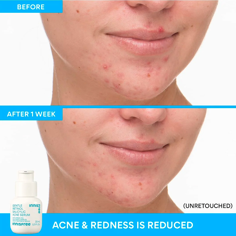 Innisfree – Gentle Retinol+Salicylic Acid Acne Serum (30ml/1.01fl.oz ...